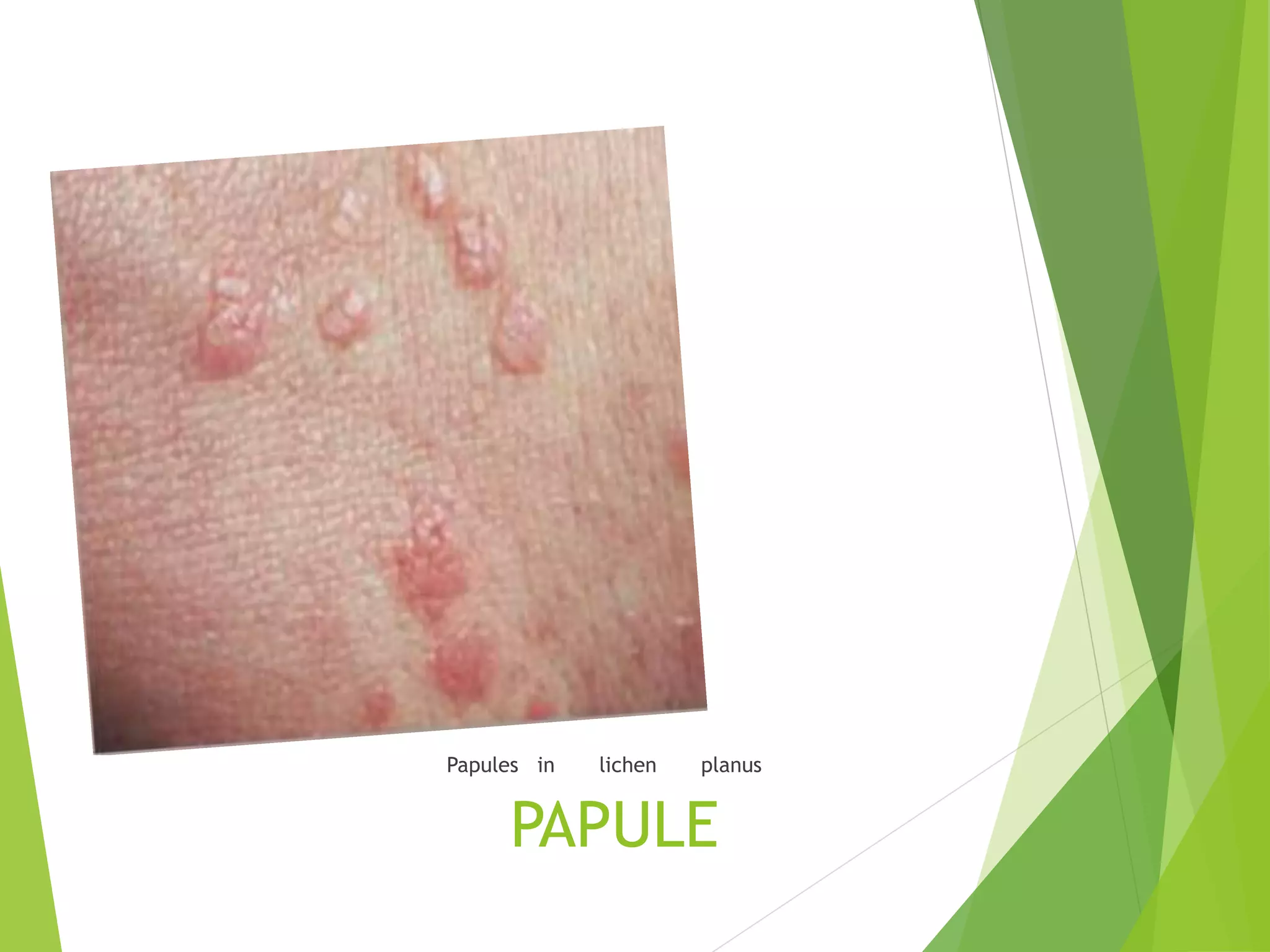 Morphologic skin lesions | PPTX