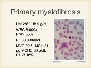 Primary Myelofibrosis Peripheral Smear