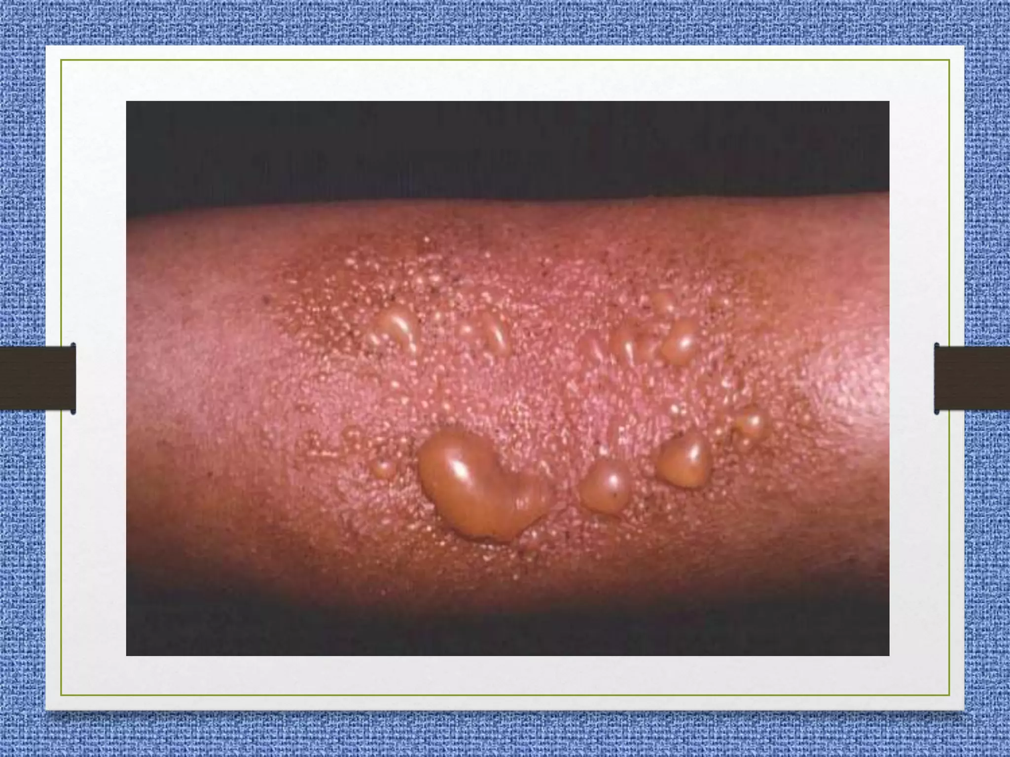 Morphology of-acute-inflammation | PPT