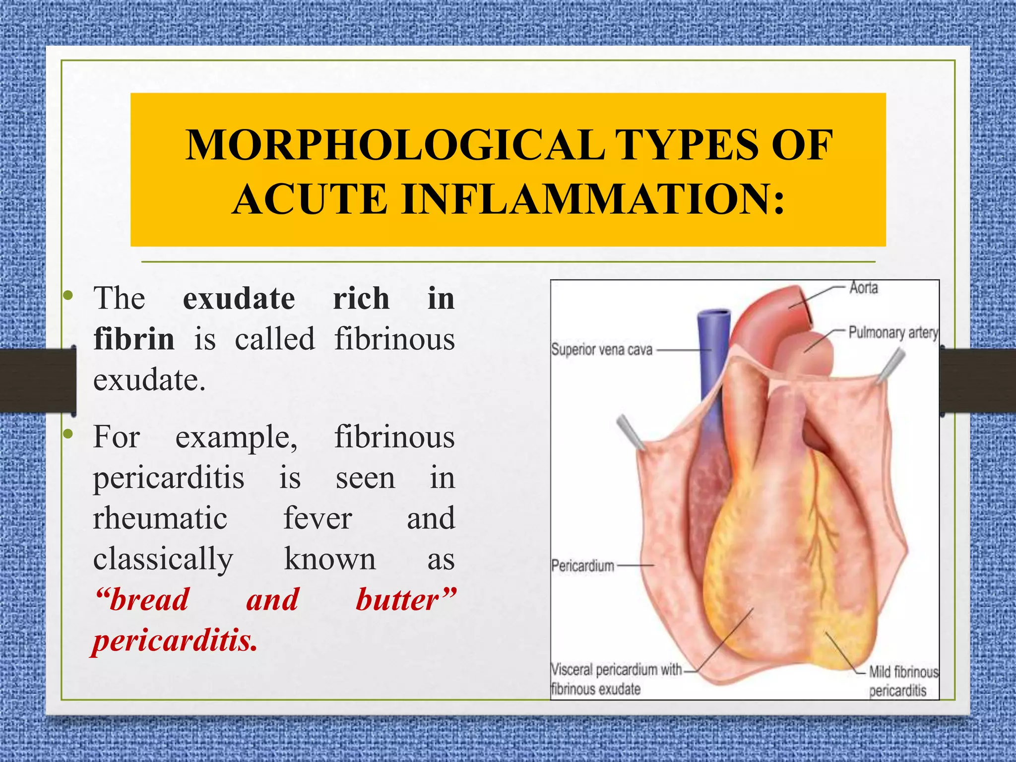 Morphology of-acute-inflammation | PPT