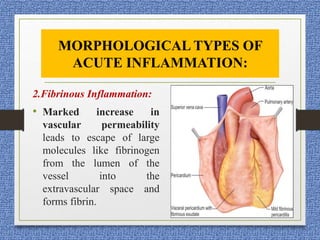 Morphology of-acute-inflammation | PPT