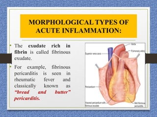 Morphology of-acute-inflammation | PPT