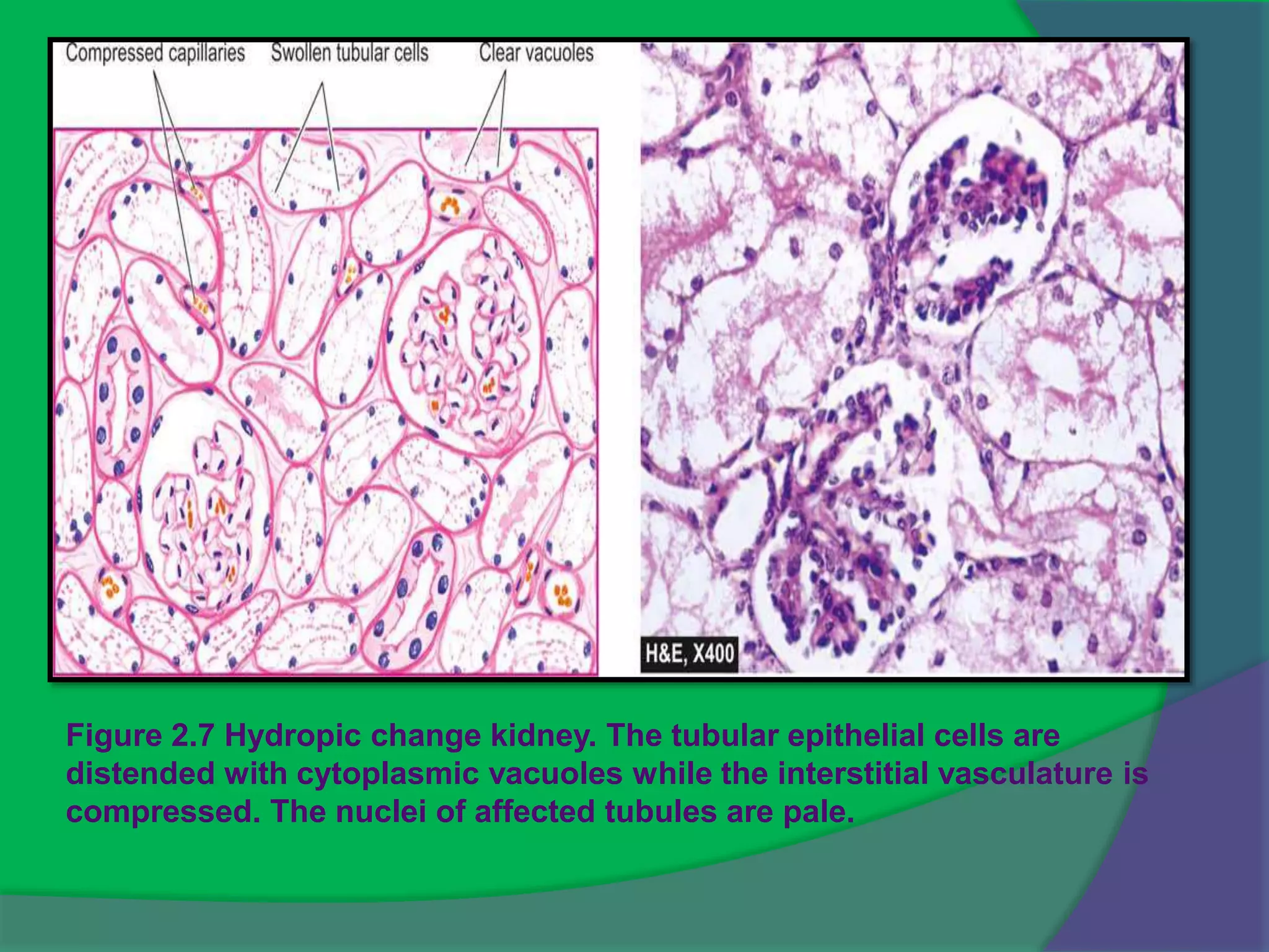 Morphology of cell injury and Intracellular accumulationspptx | PPTX
