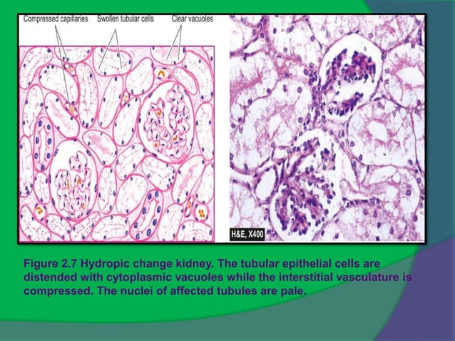 Morphology of cell injury and Intracellular accumulationspptx | PPTX ...