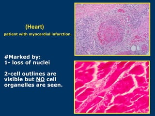 Coagulative Necrosis + Morphology | PPTX