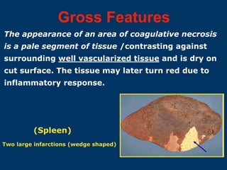 Coagulative Necrosis Gross