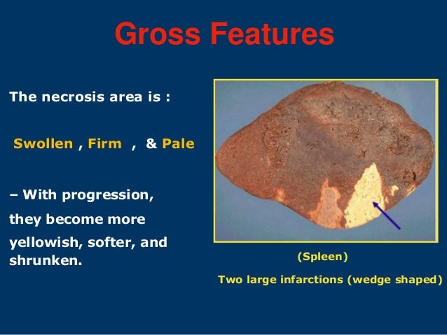 Coagulative Necrosis + Morphology