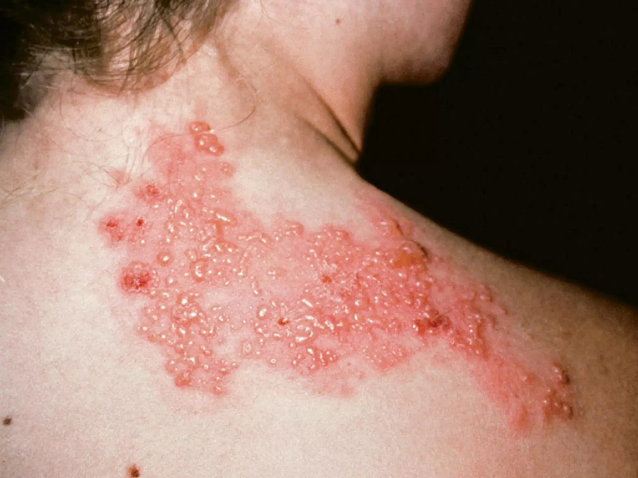 Morphology of Skin Lesions | PDF