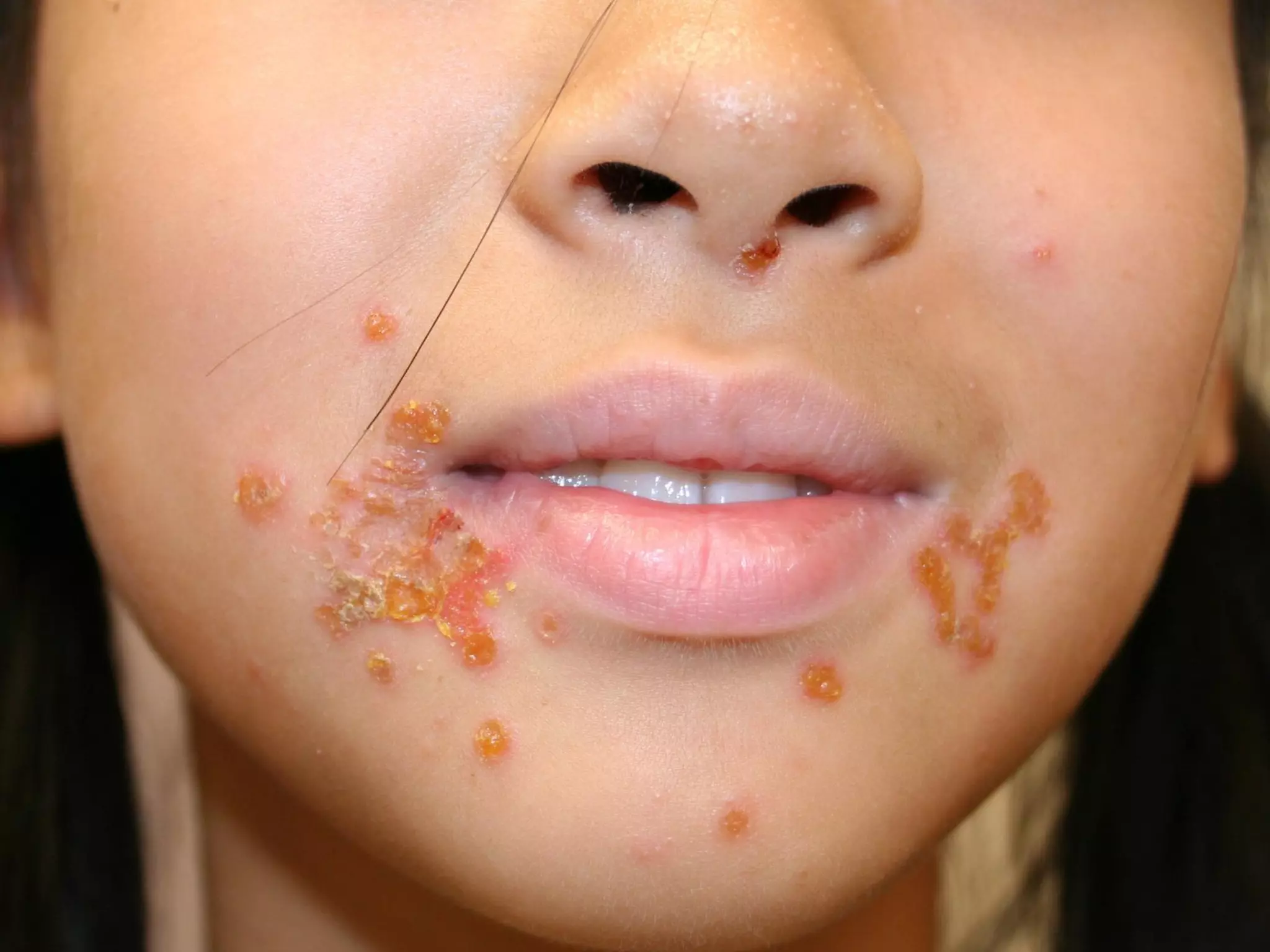 Morphology of Skin Lesions | PDF