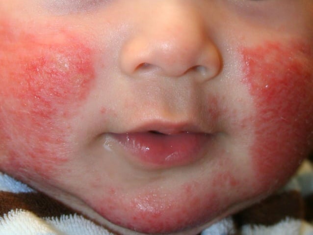 Morphology of Skin Lesions | PDF | Skin and Dermatology | Diseases and ...