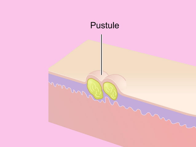 Morphology of Skin Lesions | PDF | Skin and Dermatology | Diseases and ...