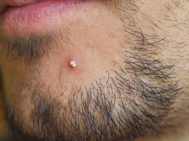 Morphology of Skin Lesions | PDF | Skin and Dermatology | Diseases and ...