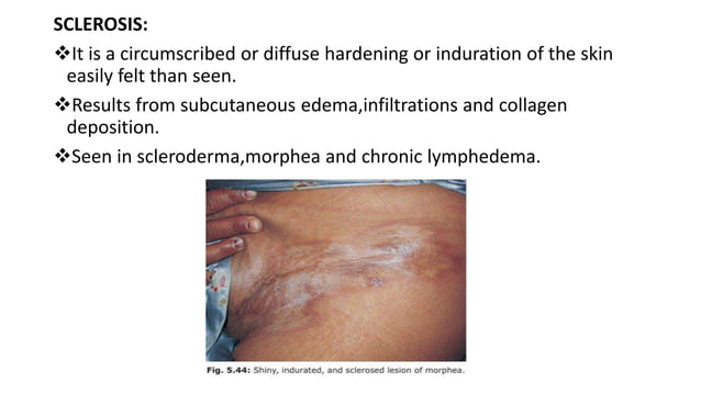 MORPHOLOGY OF SKIN LESIONS powerpoint dvl | PPT
