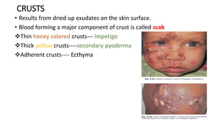 MORPHOLOGY OF SKIN LESIONS powerpoint dvl | PPTX