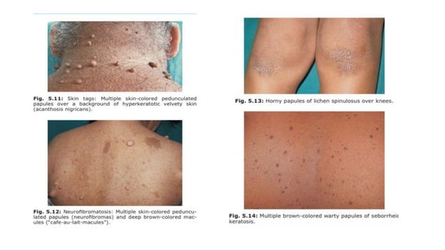 MORPHOLOGY OF SKIN LESIONS powerpoint dvl | PPT