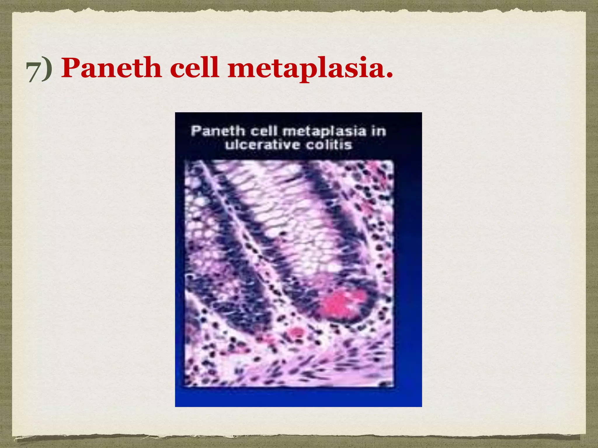 Morphology of ulcerative colitis | PPTX