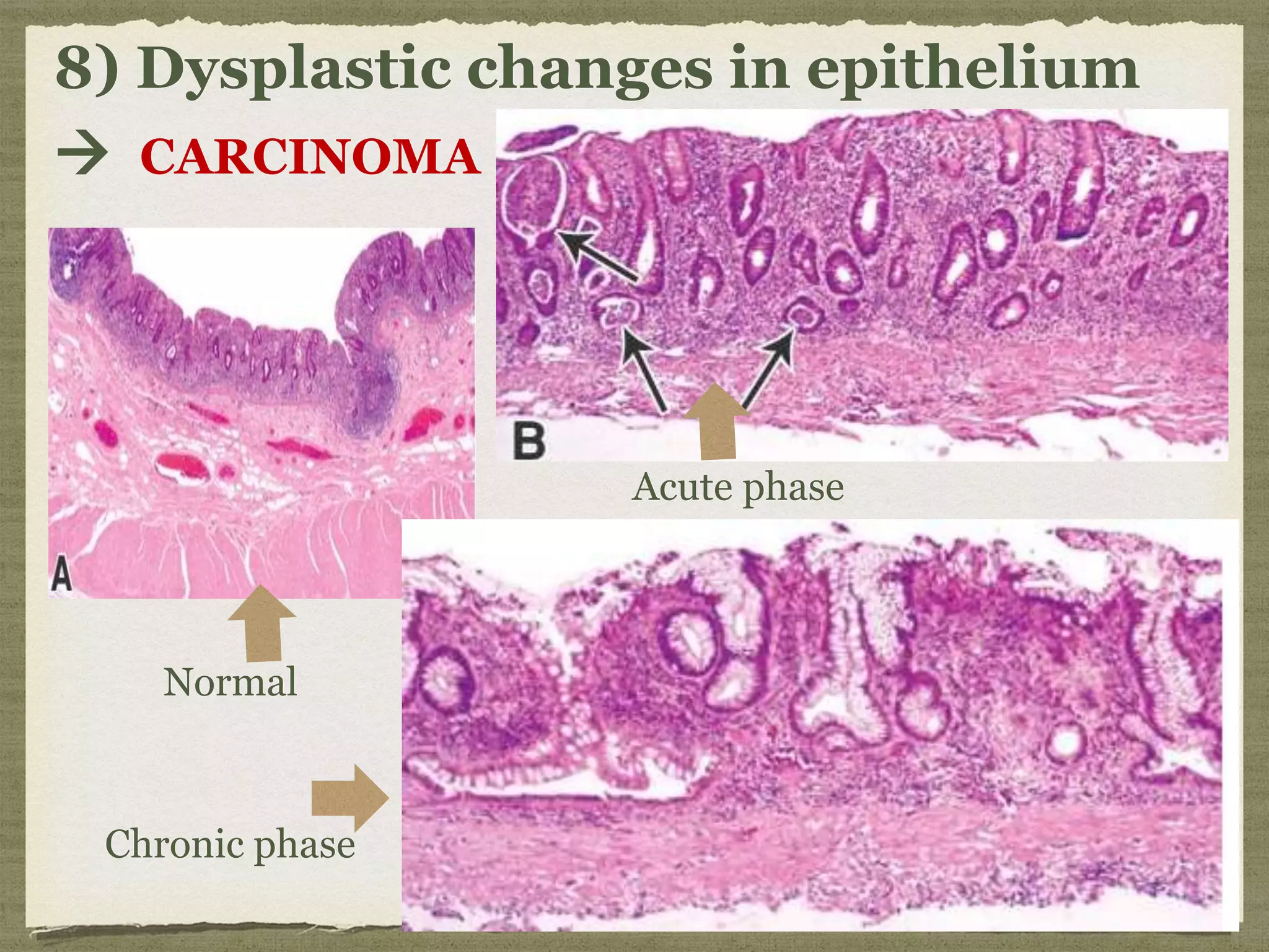 Morphology of ulcerative colitis | PPTX