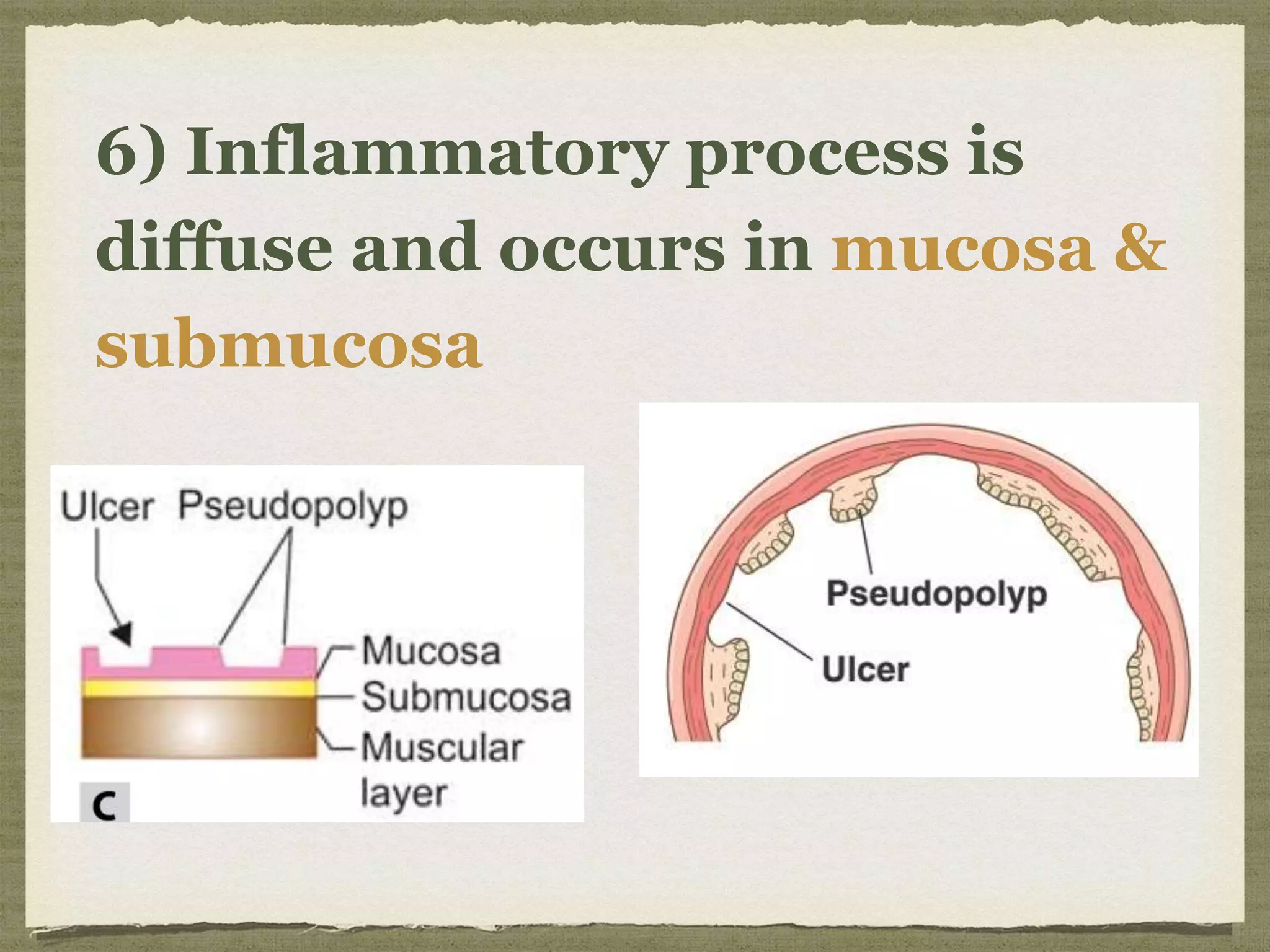 Morphology of ulcerative colitis | PPTX
