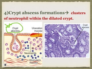 Morphology of ulcerative colitis | PPT