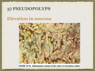 Morphology of ulcerative colitis | PPT