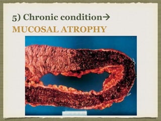 Morphology of ulcerative colitis | PPT