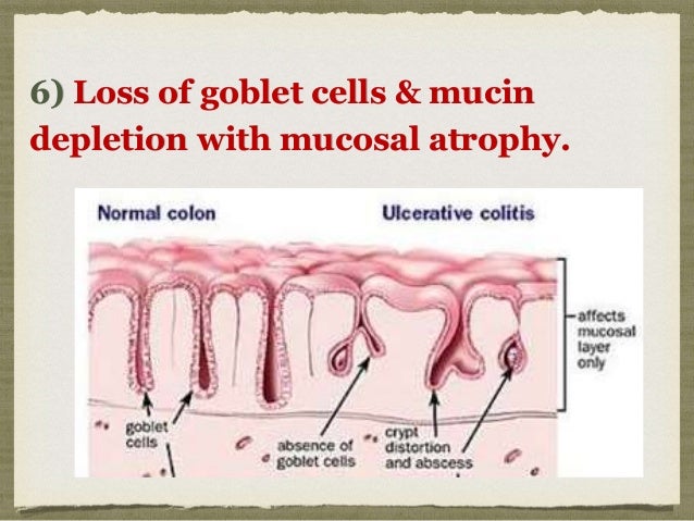 Mucous Colitis