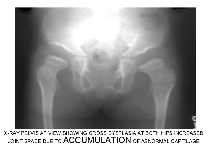 Morquio Syndrome