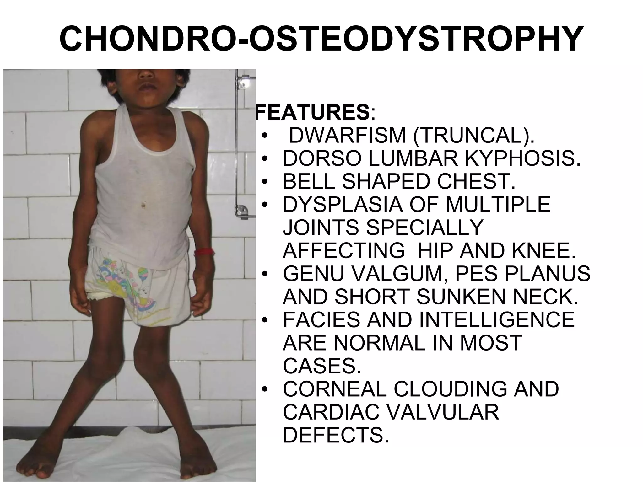 Morquio syndrome | PPT