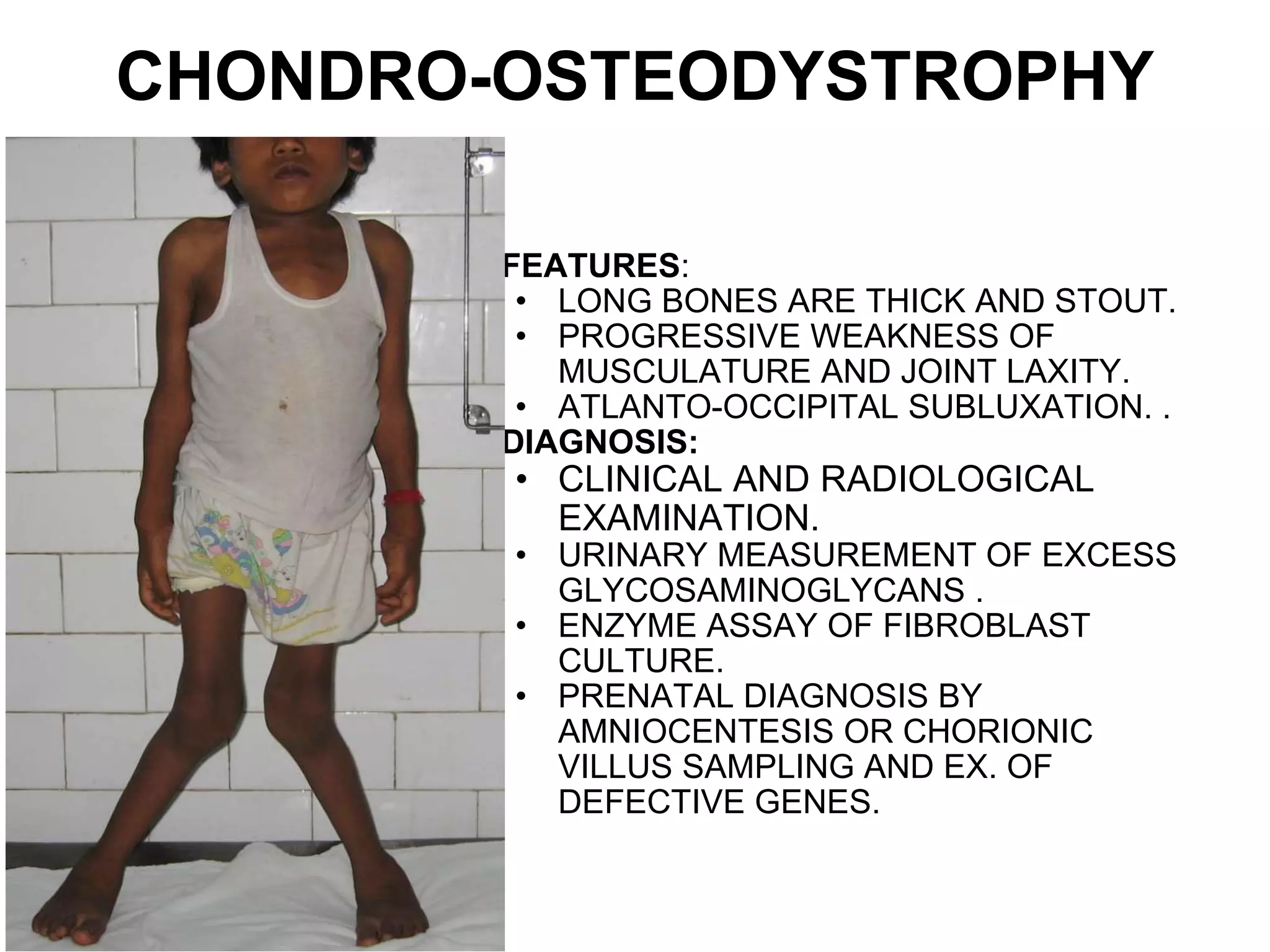 Morquio Syndrome Ppt