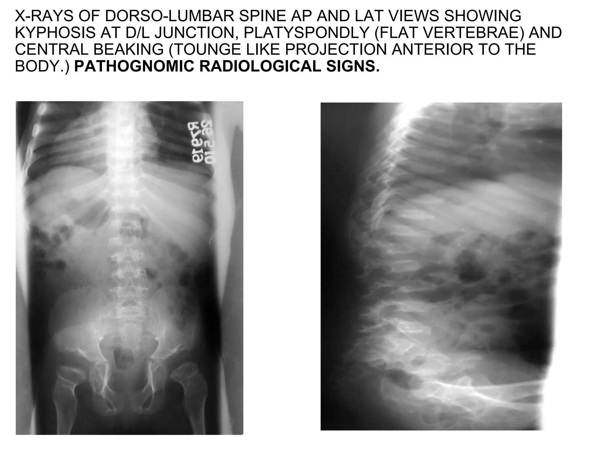 Morquio syndrome | PPT