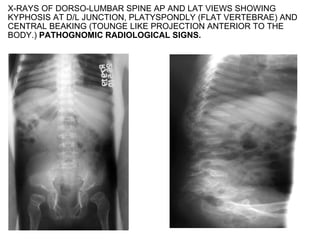 Morquio syndrome | PPT