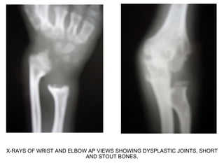 Morquio syndrome | PPT