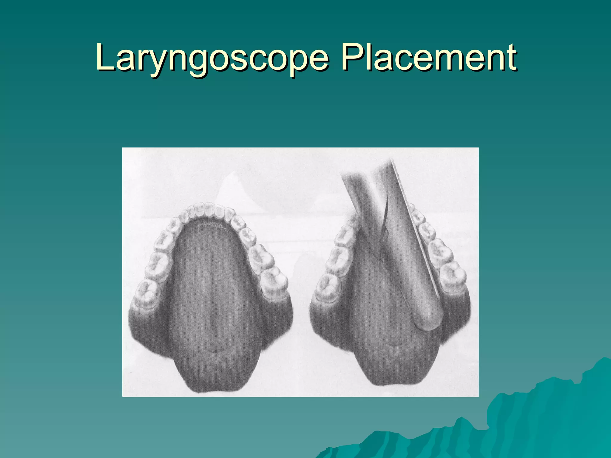 Morrissey Airway Positioning | PPT