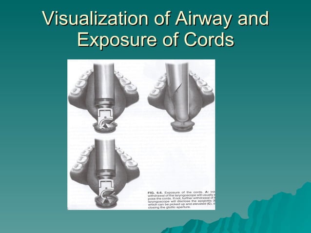 Morrissey Airway Positioning | PPT