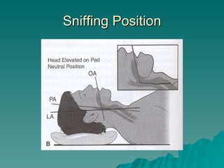 Morrissey Airway Positioning | PPT