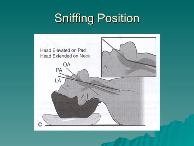 Morrissey Airway Positioning | PPT