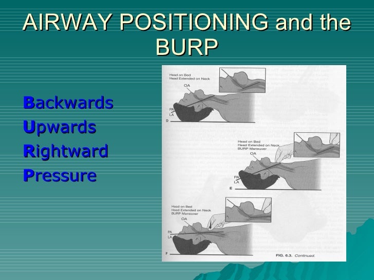 Morrissey Airway Positioning