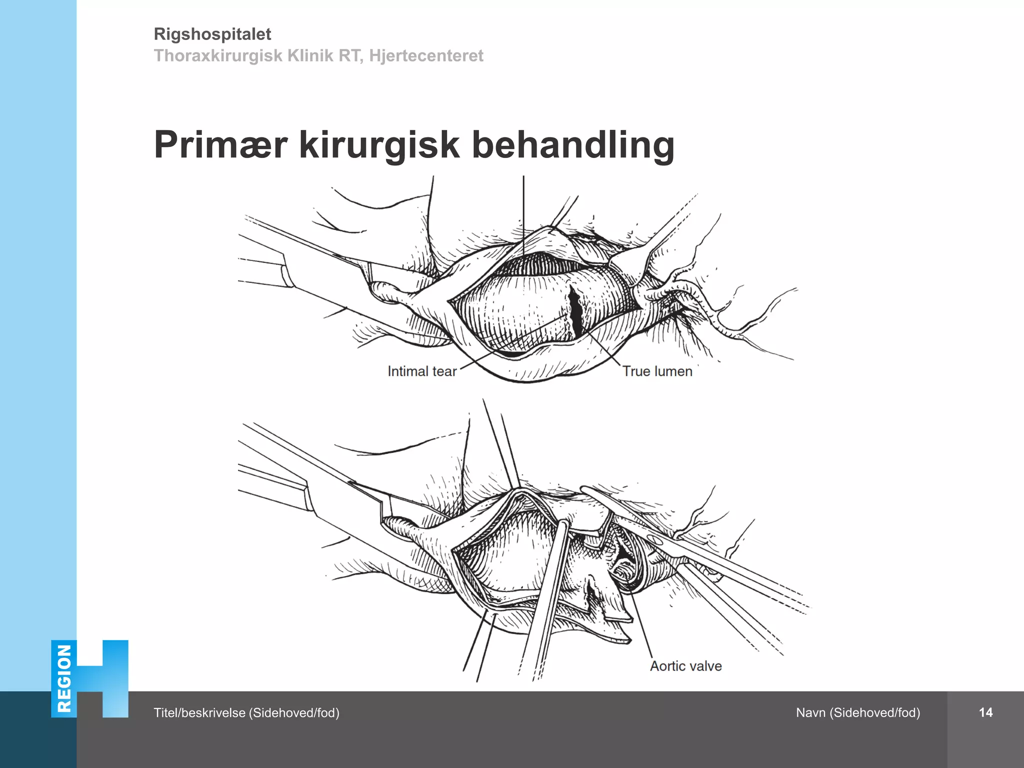 Akut aortasyndrom (aortadissektion) | PDF