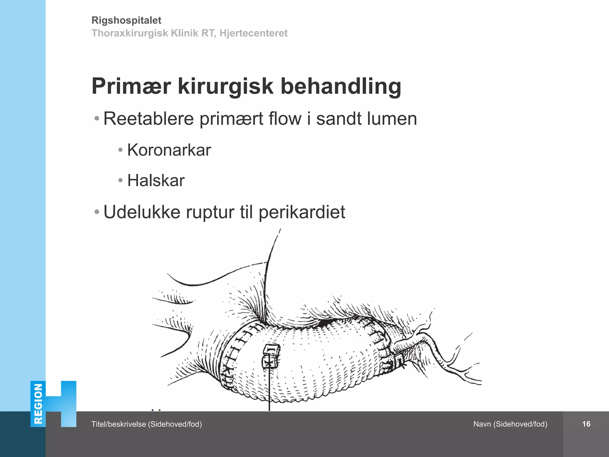 Akut aortasyndrom (aortadissektion) | PDF
