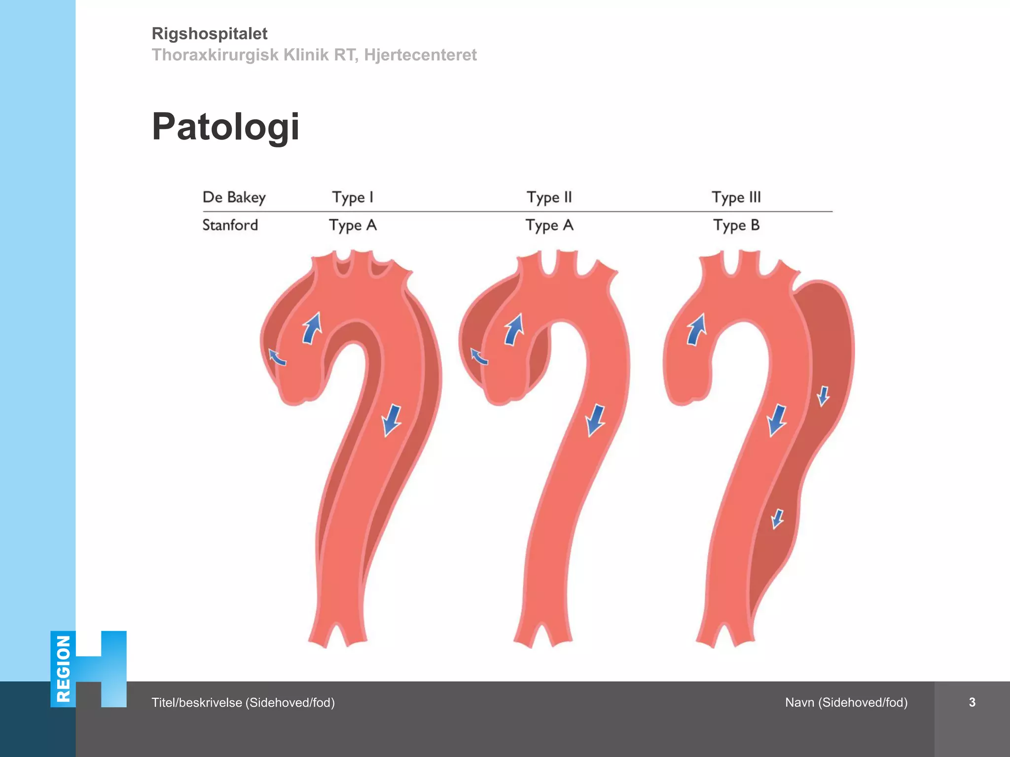 Akut aortasyndrom (aortadissektion) | PDF