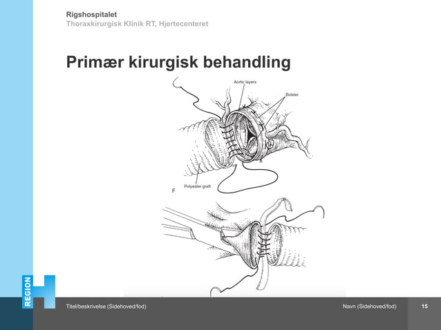 Akut aortasyndrom (aortadissektion) | PDF