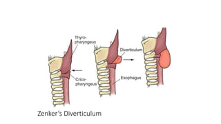 Mortility disorder of oesophagus | PPTX