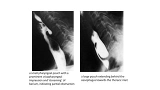 Mortility disorder of oesophagus | PPTX