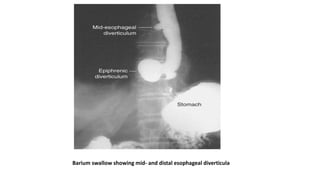 Mortility disorder of oesophagus | PPTX