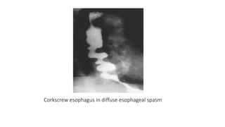 Mortility disorder of oesophagus | PPTX