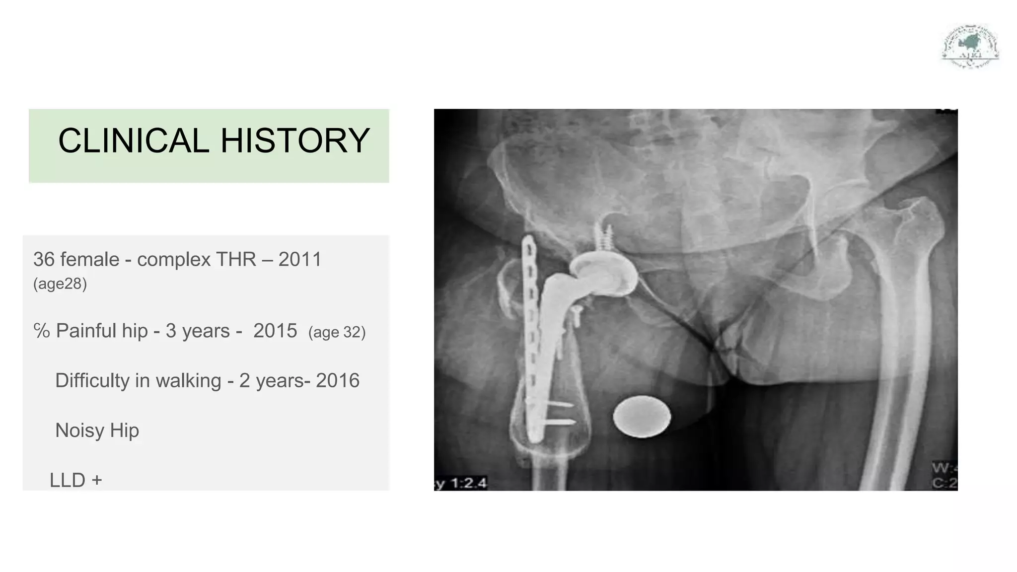 Complex Total Hip Replacement - Asian Joint Reconstruction Institute ...