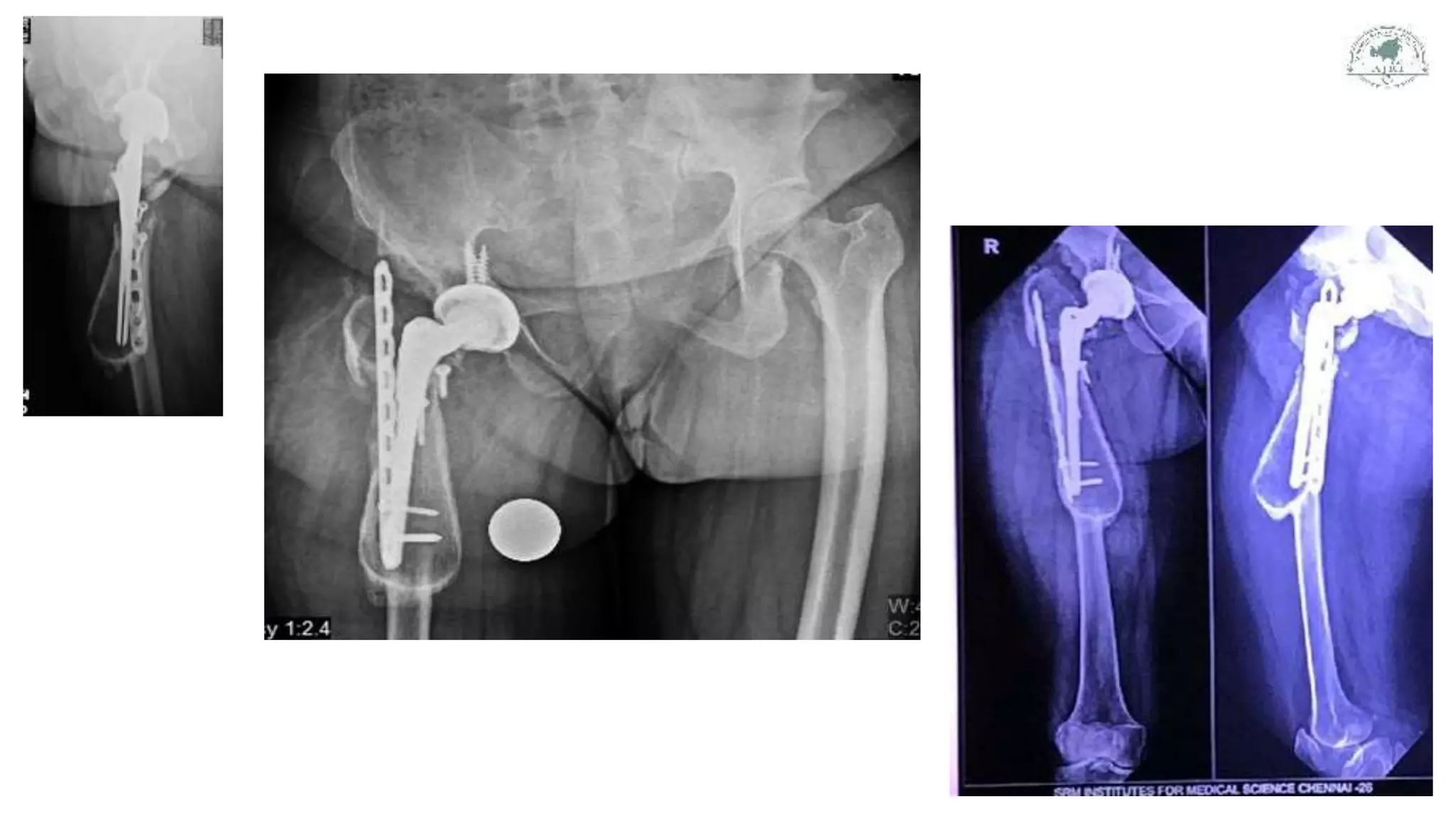 Complex Total Hip Replacement - Asian Joint Reconstruction Institute ...