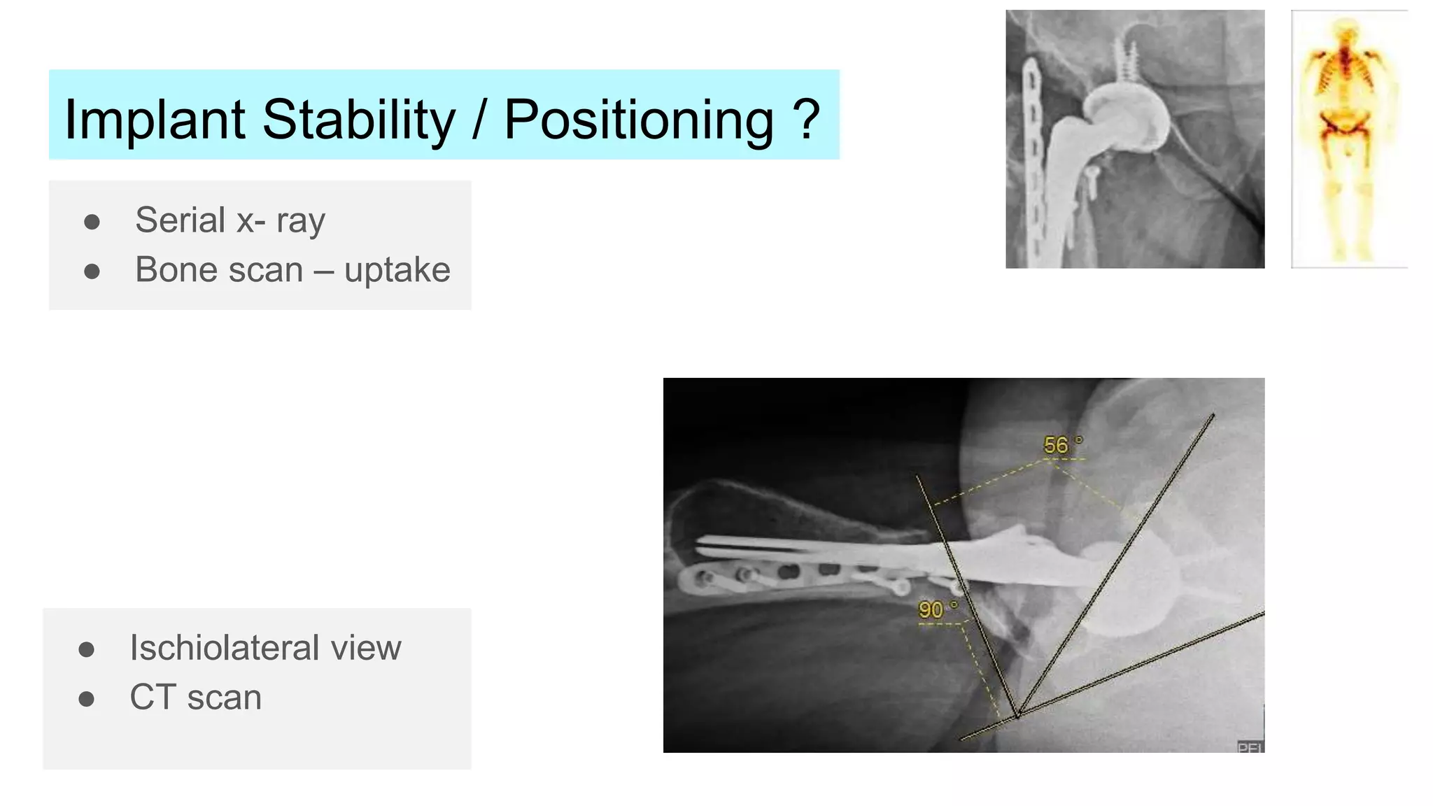 Complex Total Hip Replacement - Asian Joint Reconstruction Institute ...