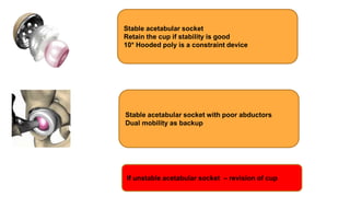 Complex Total Hip Replacement - Asian Joint Reconstruction Institute ...