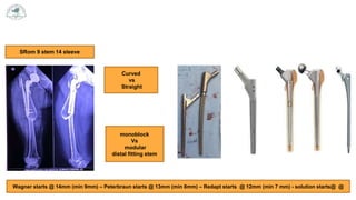 Complex Total Hip Replacement - Asian Joint Reconstruction Institute ...